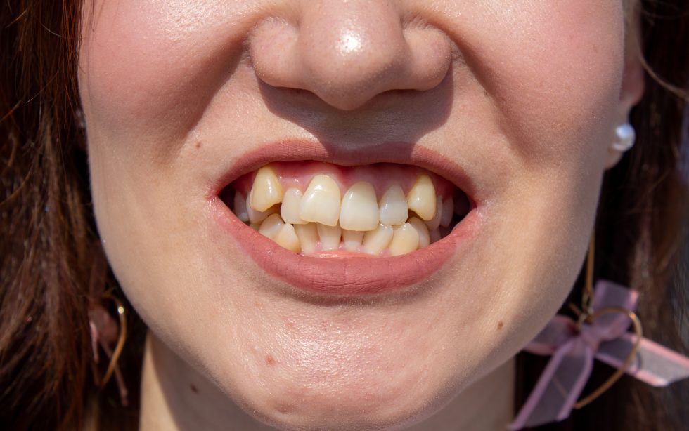 The Effect of Thumb Sucking on Teeth and How to Get Your Child to Stop ...