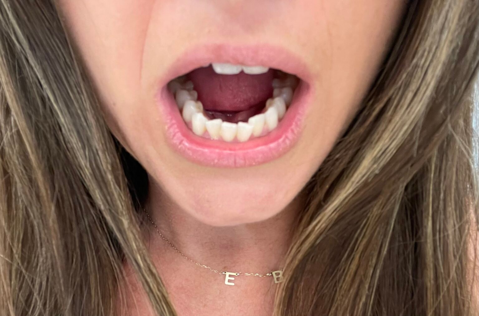 Byte Teeth Aligner Trial Before and After Review - Just Simply Mom