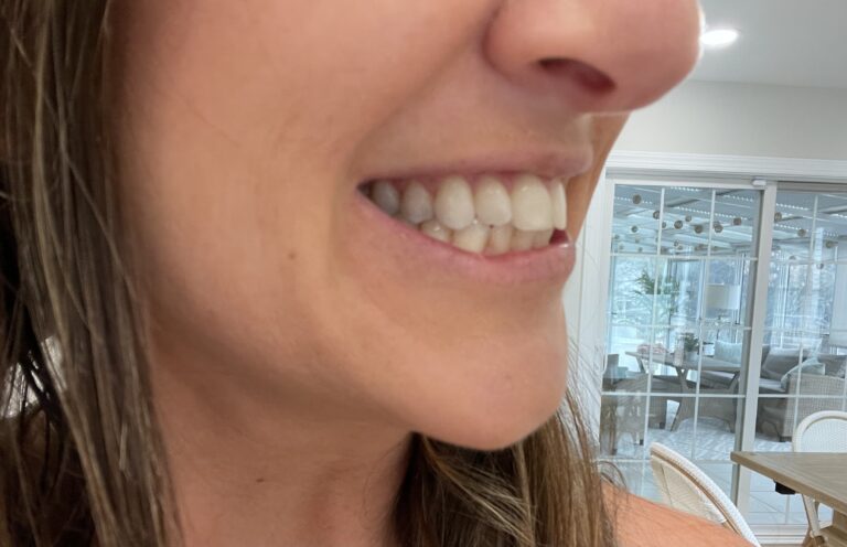 Byte Teeth Aligner Trial Before and After Review - Just Simply Mom