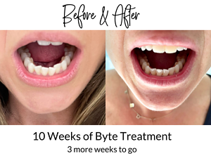 Byte Teeth Aligner Trial Before and After Review - Just Simply Mom