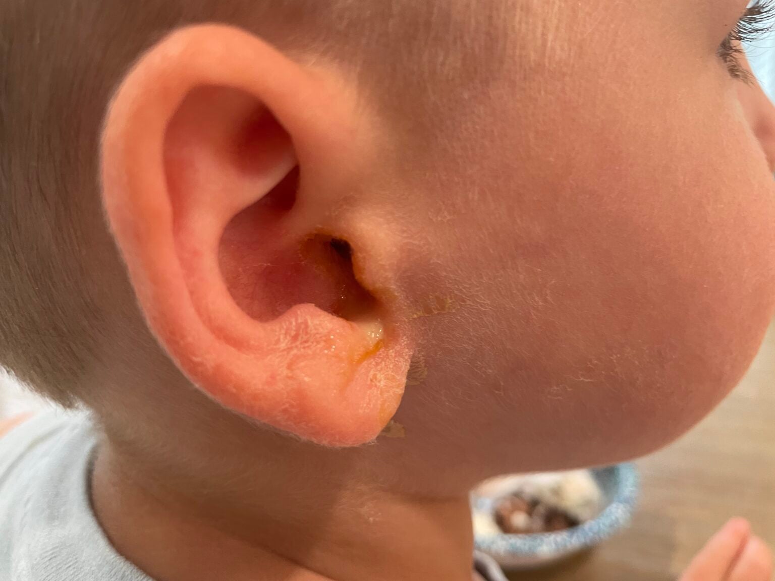 Does Your Child Have Ear Drainage With Tubes What It Is And When To